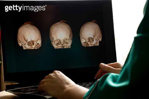 computed tomography of the brain with a fracture of the frontal part of ...