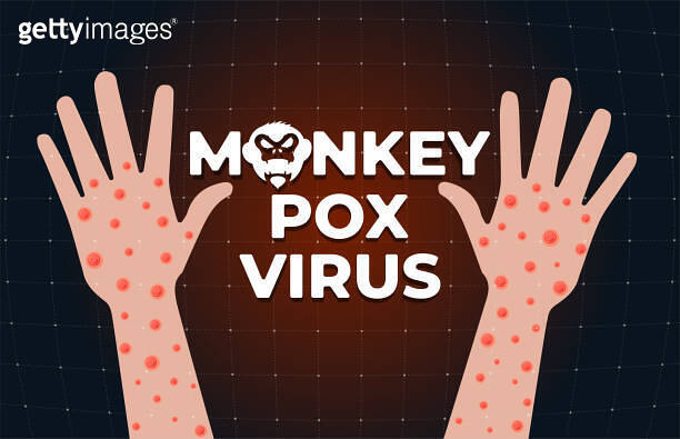 Monkeypox virus infection on hand banner concept. Monkey pox disease ...