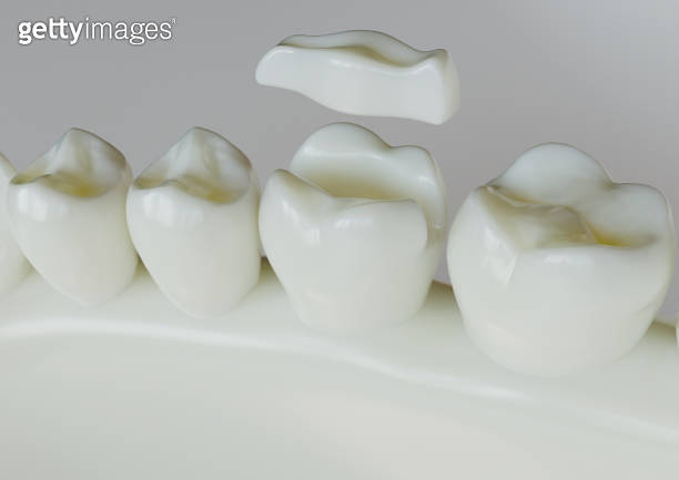 Ceramic Inlay crown over a tooth- 3D Rendering 이미지 (1442221798) - 게티이미지뱅크