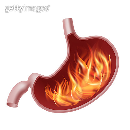 Burning stomach. Realistic human organ of internal digestion system on ...