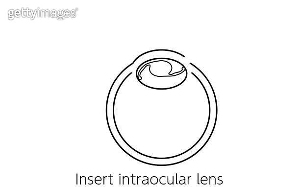 Cataract Surgery Flow, Illustration (Line Drawing), Inserting an ...