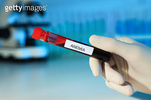 Scientist holding test tube with blood sample and label Anemia on ...