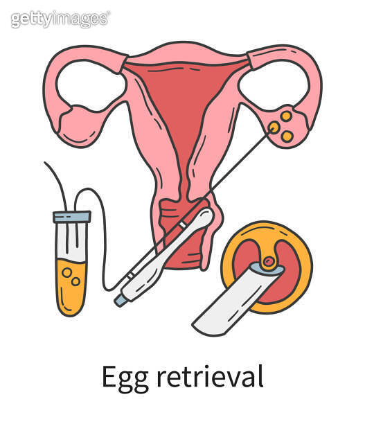 Egg retrieval and transvaginal oocyte extraction from ovaries, In Vitro ...
