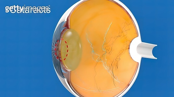 Cataract, clouding of the lens of the eye that causes decreased vision ...
