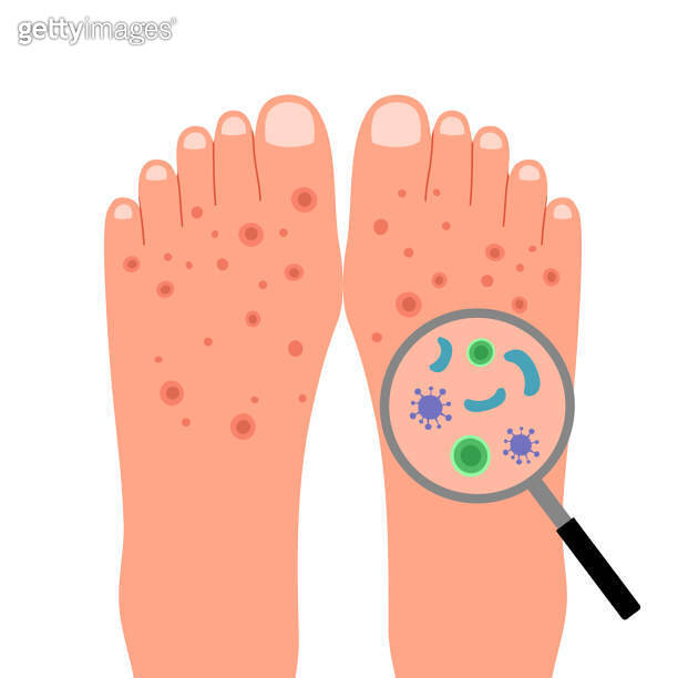 Fungal disease infection on feet skin in flat design on white ...