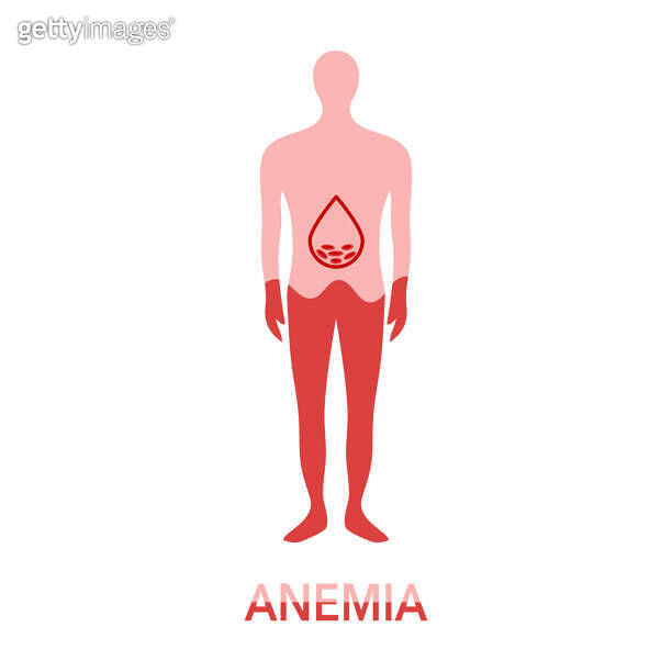 Anemia concept vector illustration. Low red blood cells in human body ...