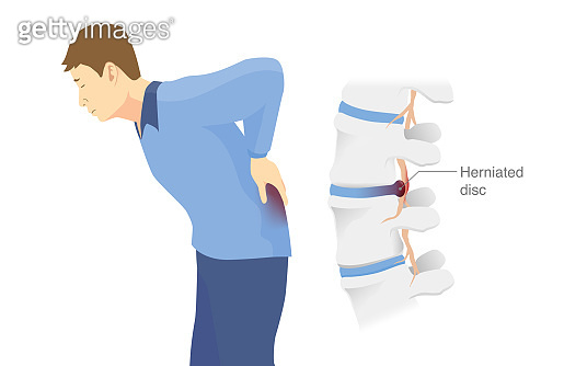 Man has low back pain and sciatica from a herniated disc. Medical ...