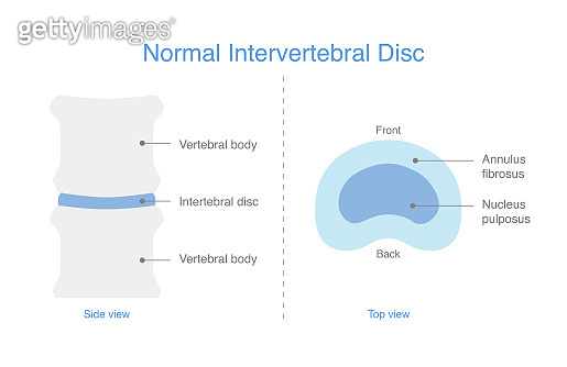 Schematic representations of the normal intervertebral disc ...