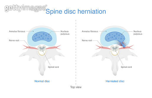 Comparing normal spine and disc herniated people is an injury to the ...