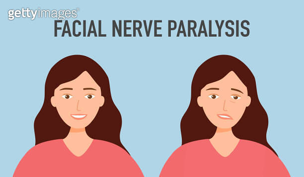 Facial nerve paralysis concept vector illustration. Face palsy ...