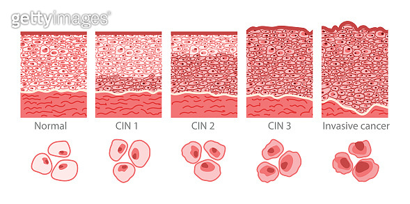 Cervical cancer cells elongated Dysplasia stages infographic Female ...