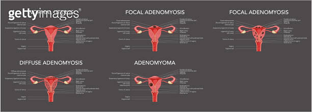Set of Adenomyosis, Human anatomy Female reproductive Sick system ...