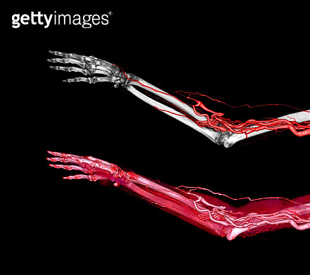 Brachial Arteries of the arm with Upper extremity Bone 3D rendering ...