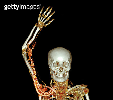 Brachial Arteries of the arm with Upper extremity Bone 3D rendering ...