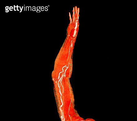 Brachial Arteries of the arm with Upper extremity Bone 3D rendering ...
