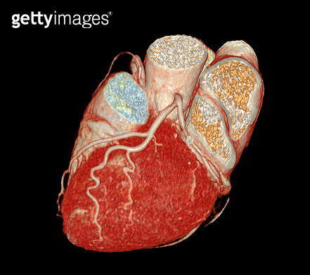 CT Cardiac 3D 이미지 (1436061752) - 게티이미지뱅크