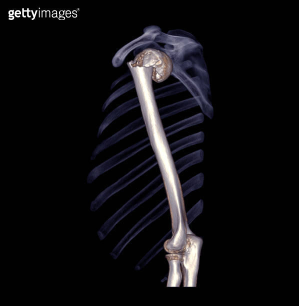 CT scan of shoulder joint and humerus bone or arm. (1421270417) 일러스트 ...