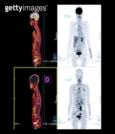 Positron emission tomography (PET) CT scan of Whole human body. 이미지 ...