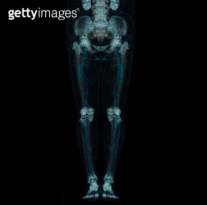 CT scan of lower extremity ,3D illustration of Femur bone , knee joint ...