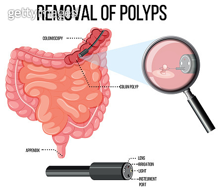 Diagram showing removal of polyps 이미지 (1420475891) - 게티이미지뱅크
