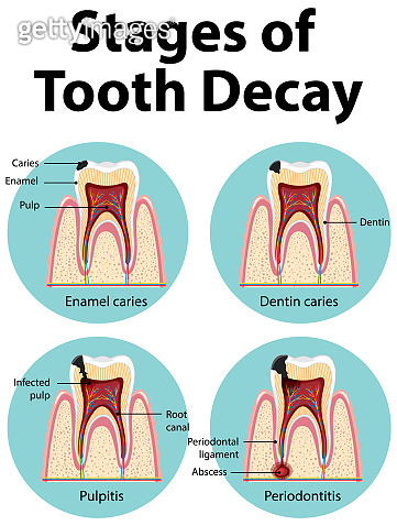 Infographic of human in the stages of tooth decay 이미지 (1420441934) - 게티 ...