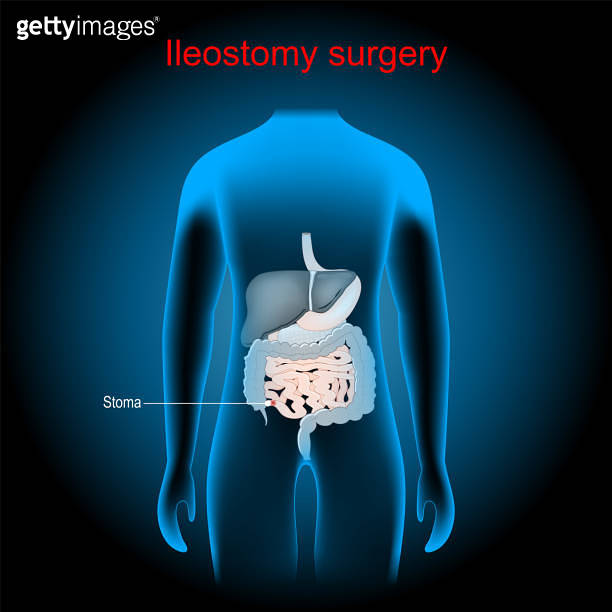 Ileostomy. stoma. surgical opening of small intestine, 이미지 (1442564604 ...
