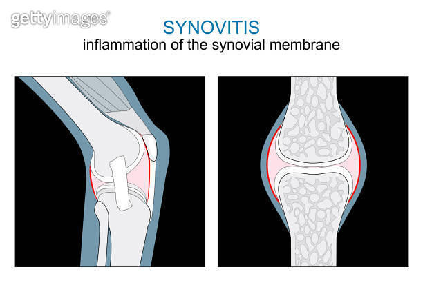 ynovitis. inflammation of the synovial membrane. Knee and Synovial ...