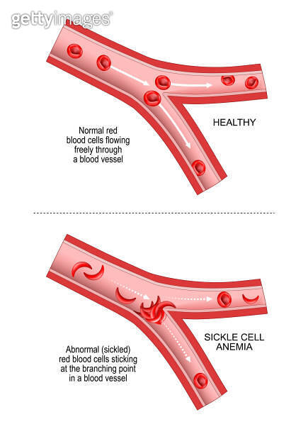 blood vessel and erythrocytes of healthy person and abnormal red blood ...