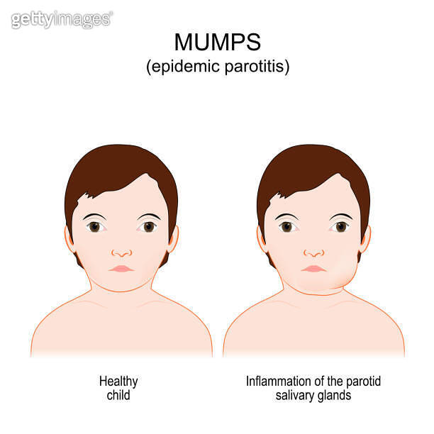 Mumps. Epidemic parotitis. viral disease (1413107557) 일러스트, 무료 일러스트 ...