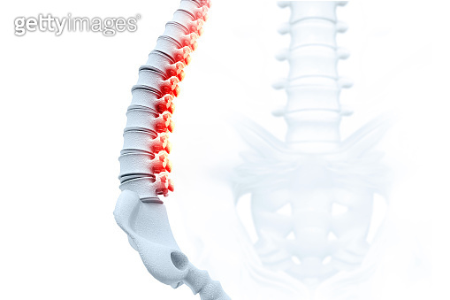 Lumbar intervertebral spine hernia. Spinal Fracture and traumatic ...