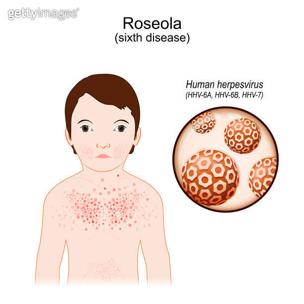 Roseola. sixth disease. infectious disease. human herpes viruses ...