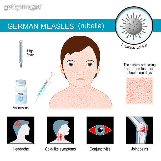 German measles. infographics about symptoms of Rubella (1436470079 ...