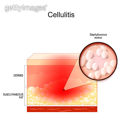 cellulitis. layers of the human Skin. Close-up of Staphylococcus aureus ...