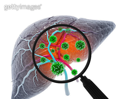 Medically accurate illustration of diseased liver. Virus infected liver ...