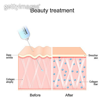 Beauty treatment. Human skin before and after procedure. 이미지 ...