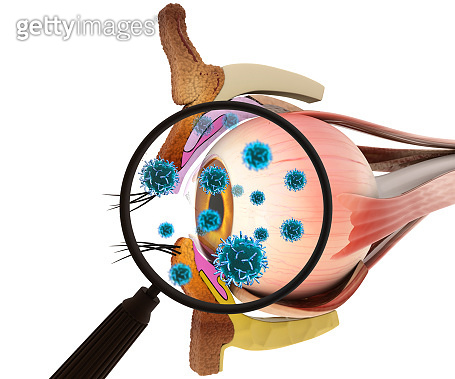 Virus or bacteria infected eyes, eye disease, 3d illustration ...