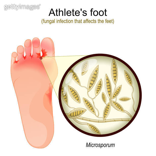 Athlete's foot. fungal infection that affects the feet. (1407498185 ...