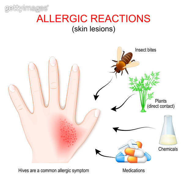 allergic reaction and skin lesions. Human hand with skin rash 이미지 ...