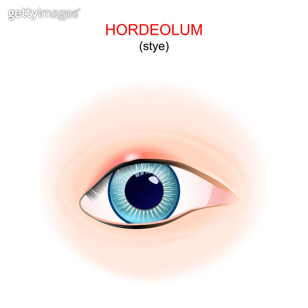 stye. eye with hordeolum on the upper eyelid. 이미지 (1396332852) - 게티이미지뱅크