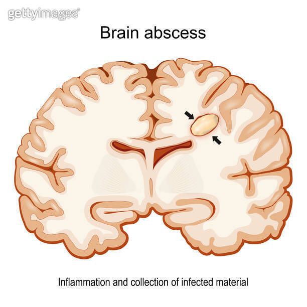 Brain abscess. Cerebral abscess. Cross section of a human brain with ...