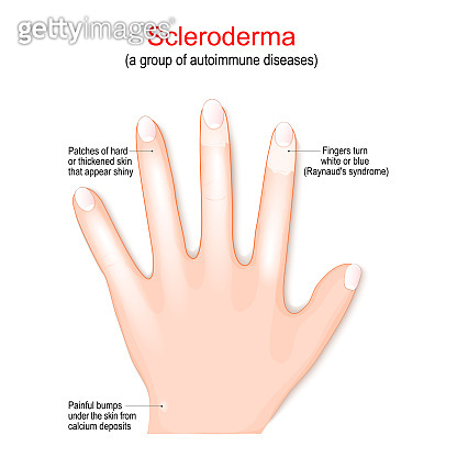 Scleroderma. autoimmune disease. Signs and symptom (1398074129) - 게티이미지뱅크