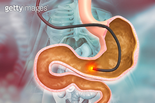 Human Stomach with endoscope and close-up view of bacterium ...