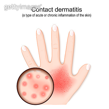 Contact dermatitis. Atopic eczema (1401700176) - 게티이미지뱅크