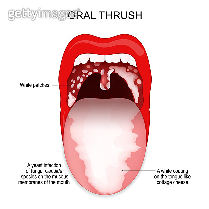 Oral thrush. A white coating on the tongue and White patches in throat ...