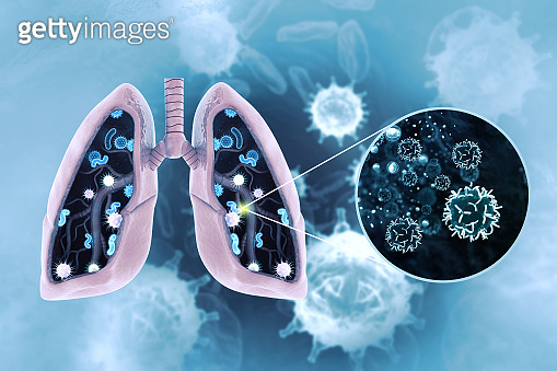 Virus and bacteria infected the Human lungs. lung disease.3d ...