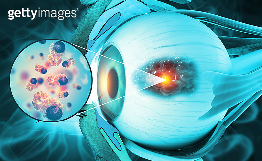 Eye cancer, eye disease, human eyeball with cancerous cells spreading ...