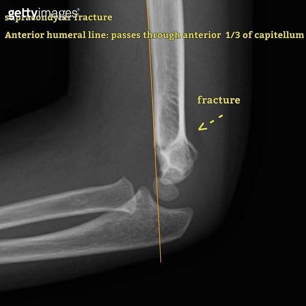 Supracondylar Fracture X Ray 이미지 1396667462 게티이미지뱅크