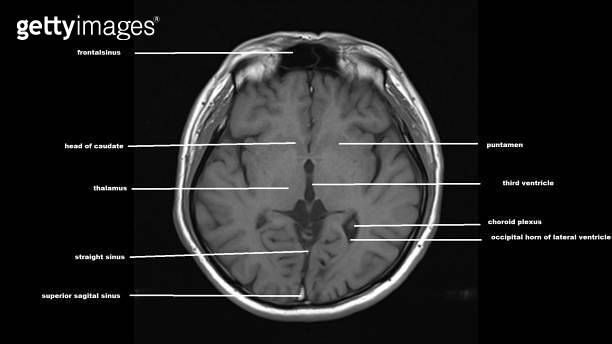 normal brain anatomy MRI 이미지 (1393255573) - 게티이미지뱅크