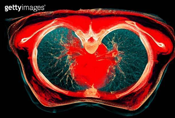Coloured 3d Chest ct scan 이미지 (1398590914) - 게티이미지뱅크