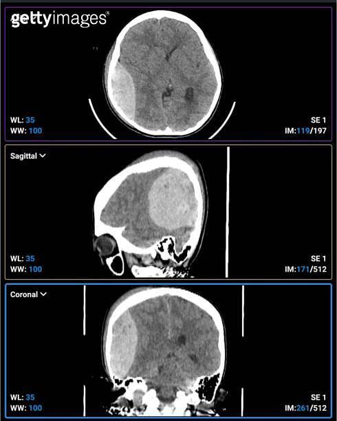Traumatic brain injury ct scan 이미지 (1394793075) - 게티이미지뱅크